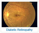 Diabetic Retinopathy: Symptoms & Treatment | ISEC