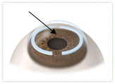 Intracorneal Rings (ICR) for Vision Correction | ISEC