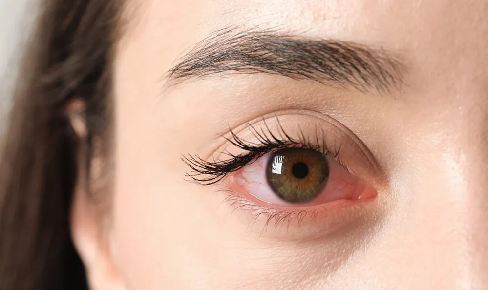What are Red Eyes?: Causes, Symptoms & Treatment - INTERNATIONAL ...