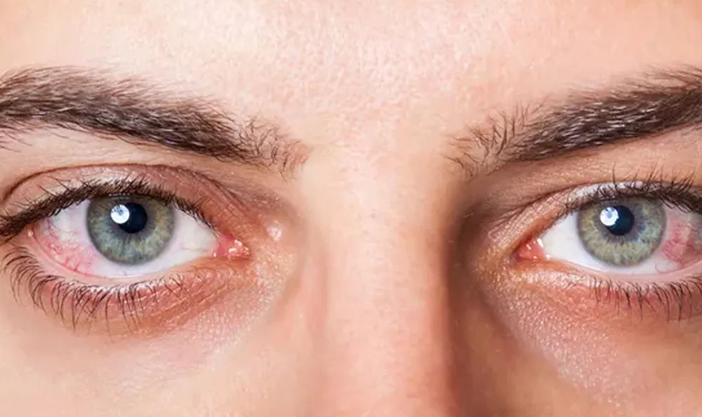 Hypertensive Retinopathy: Causes, Symptoms & Treatment - INTERNATIONAL ...